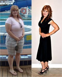 Gastric Banding Surgery | LAP Band Surgery | Surgical Arts of Inland Empire